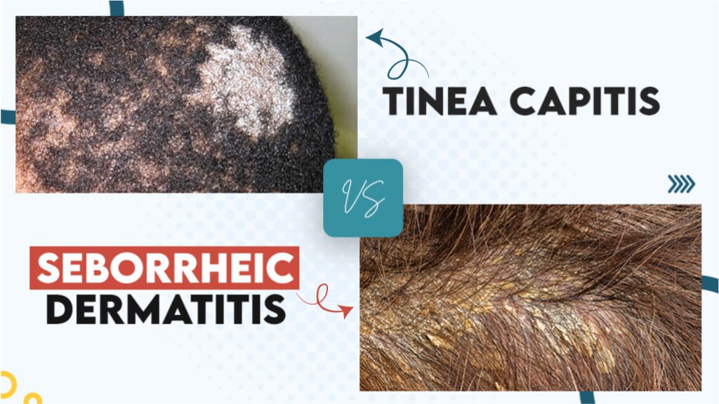What is Seborrheic Dermatitis: Causes, Symptoms & Effective Treatments ...